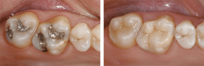 Porcelain Fillings and Crowns - Cherry Creek, Denver - Ascent Dental Group