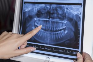 Wisdom Teeth Extraction Cherry Creek, Denver - Coronectomy Wisdom Teeth